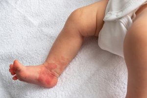 Baby Birthmarks: Types and Treatment - Mum Stuff